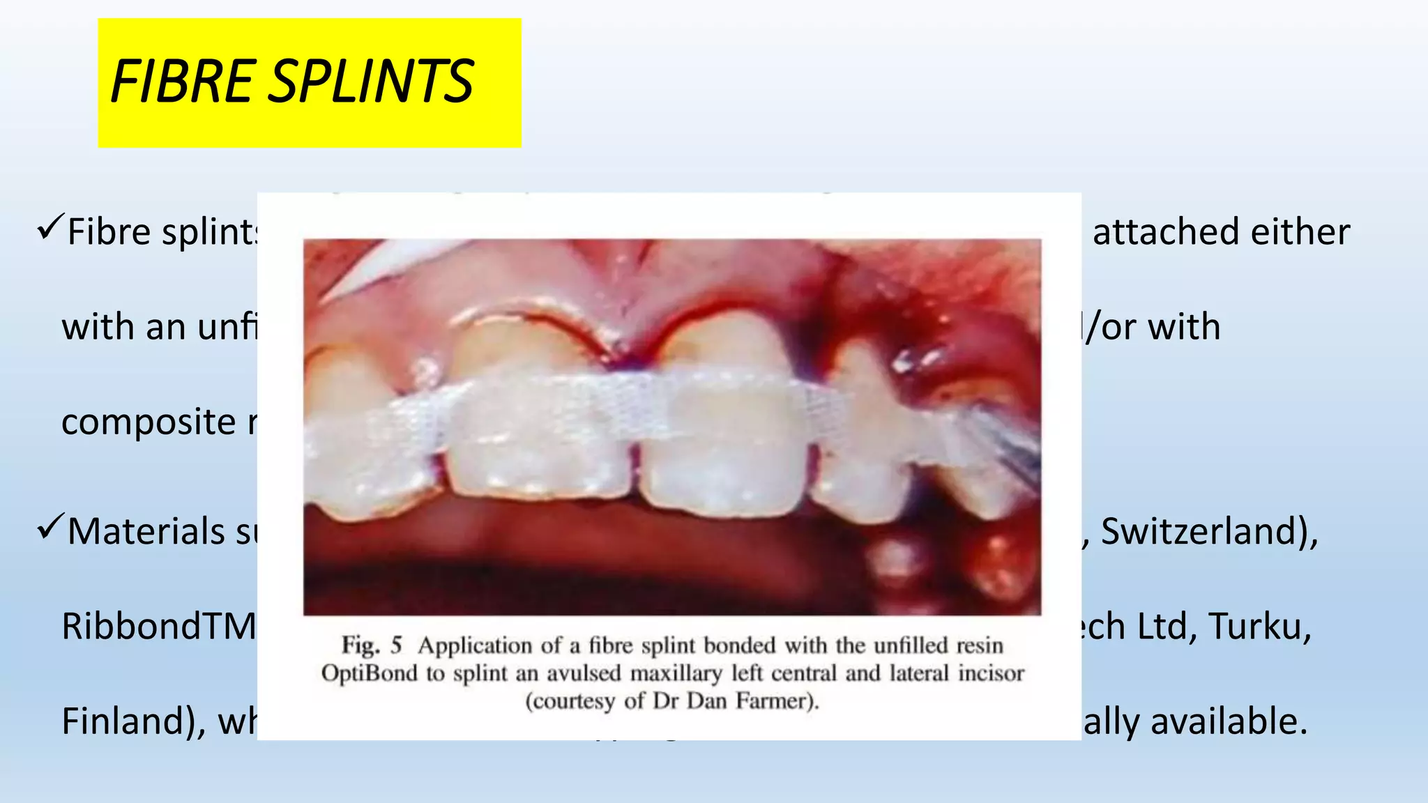 Splinting of traumatized teeth | PPTX