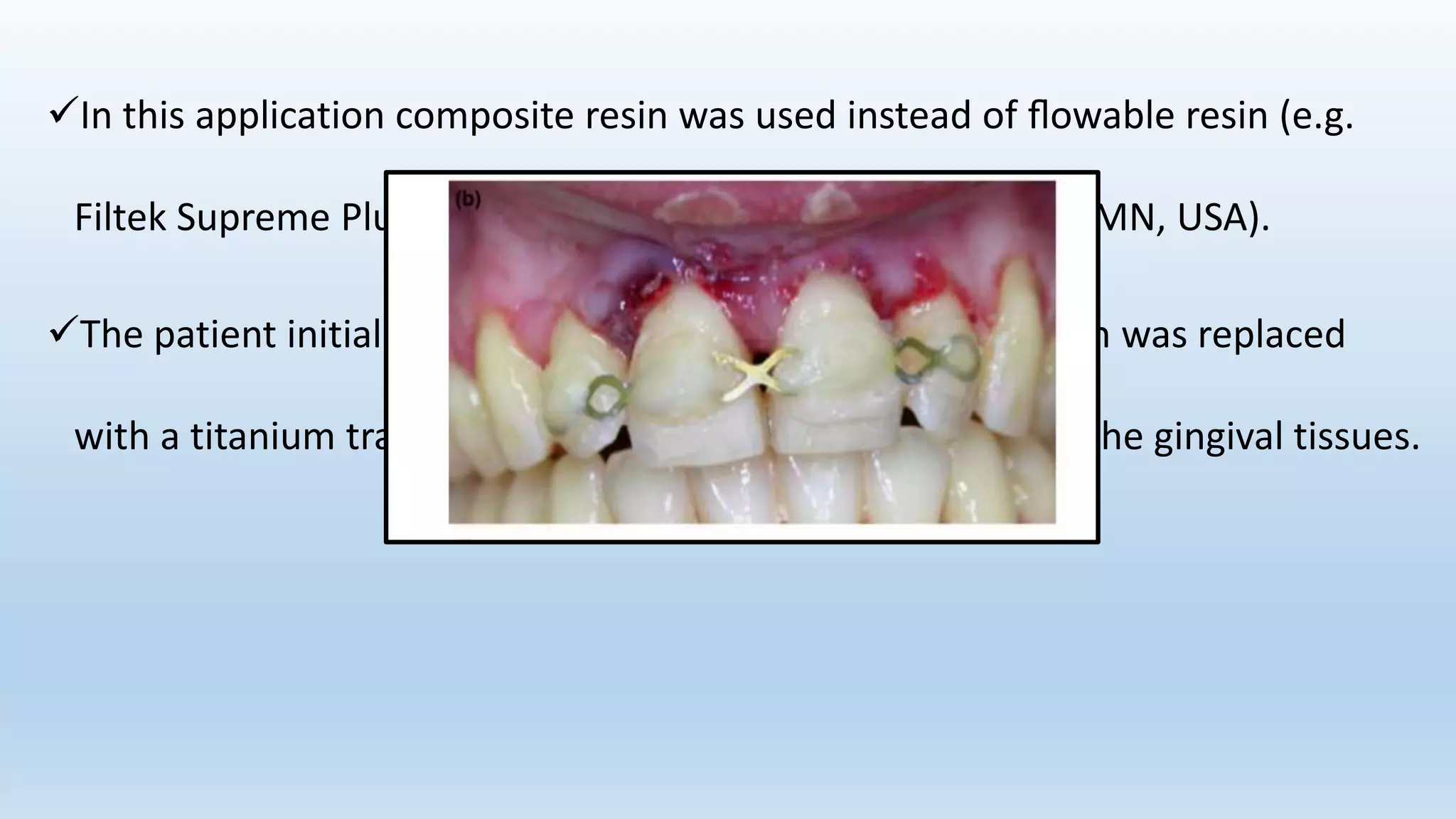 Splinting of traumatized teeth | PPTX