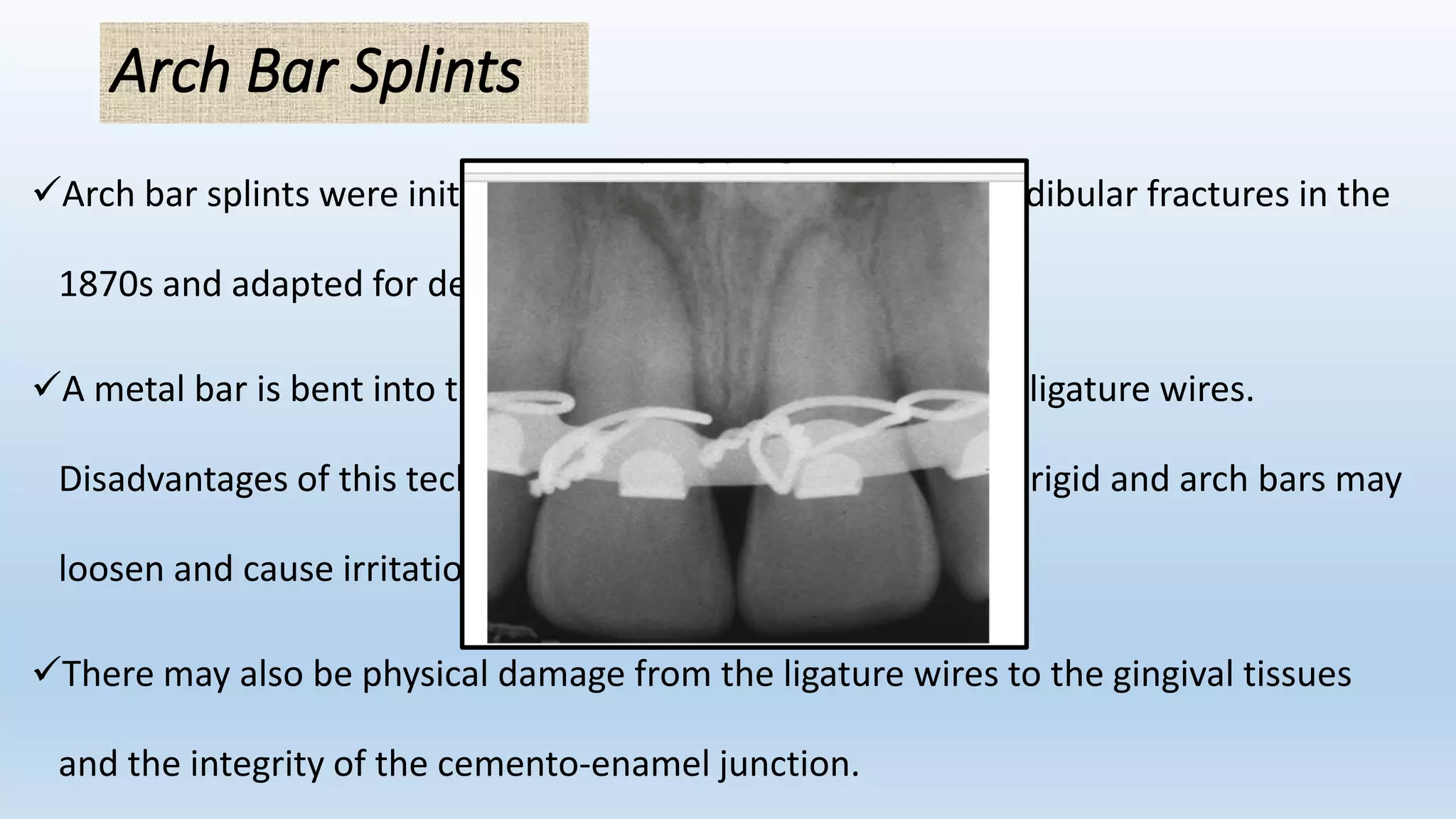 Splinting of traumatized teeth | PPTX