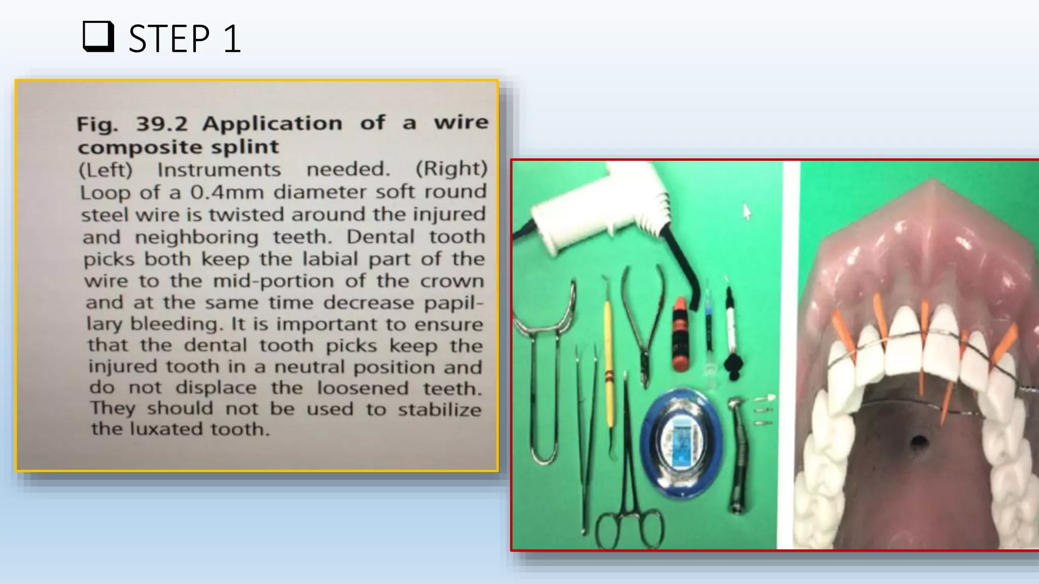 Splinting of traumatized teeth | PPTX