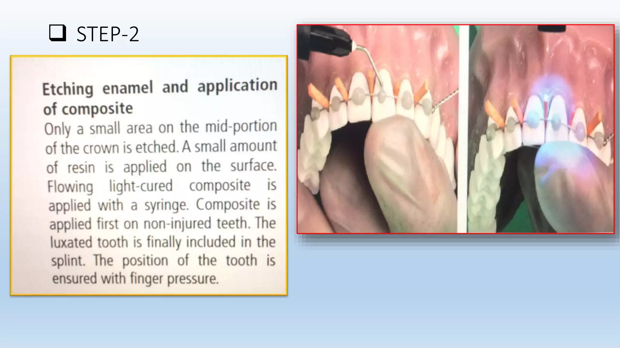 Splinting of traumatized teeth | PPTX