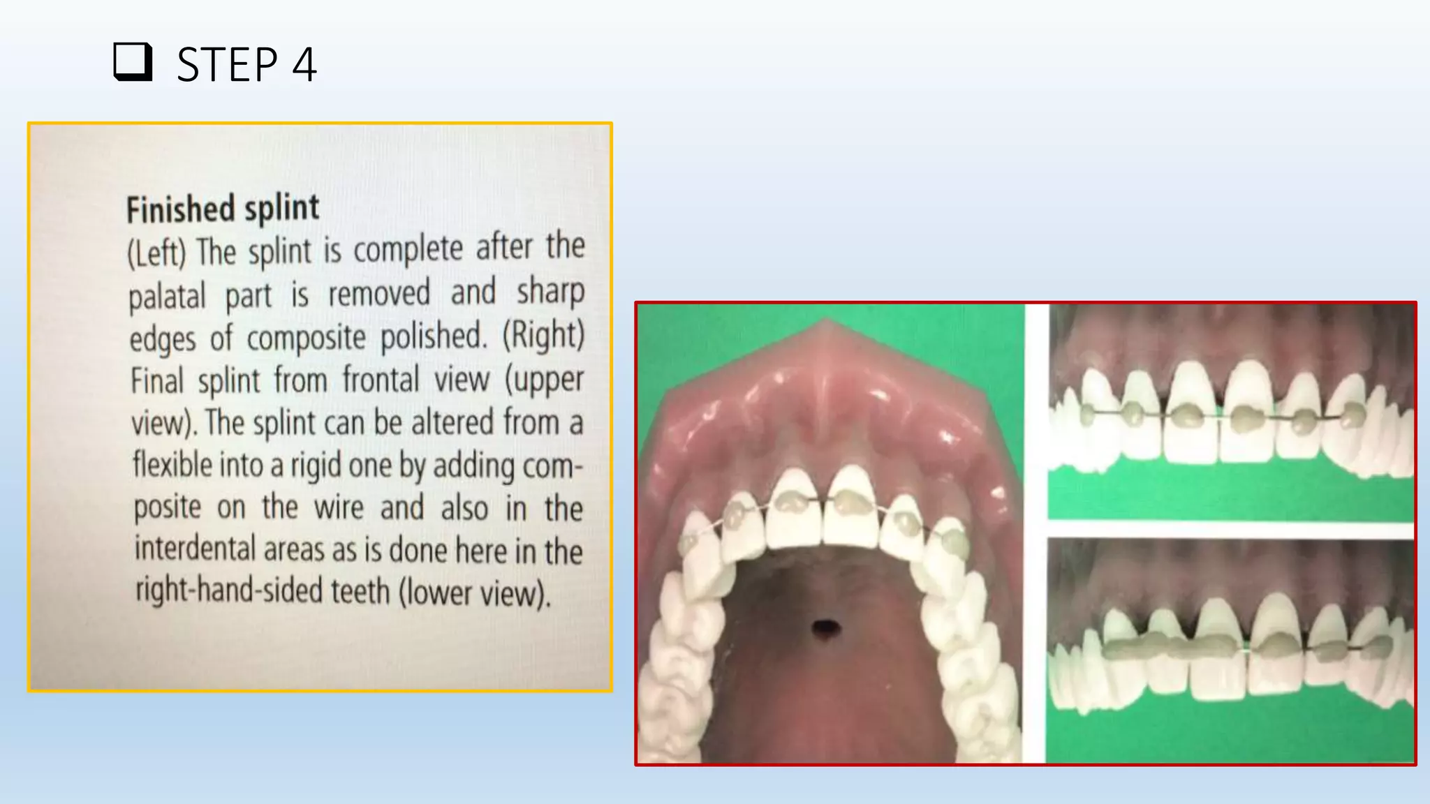 Splinting of traumatized teeth | PPTX