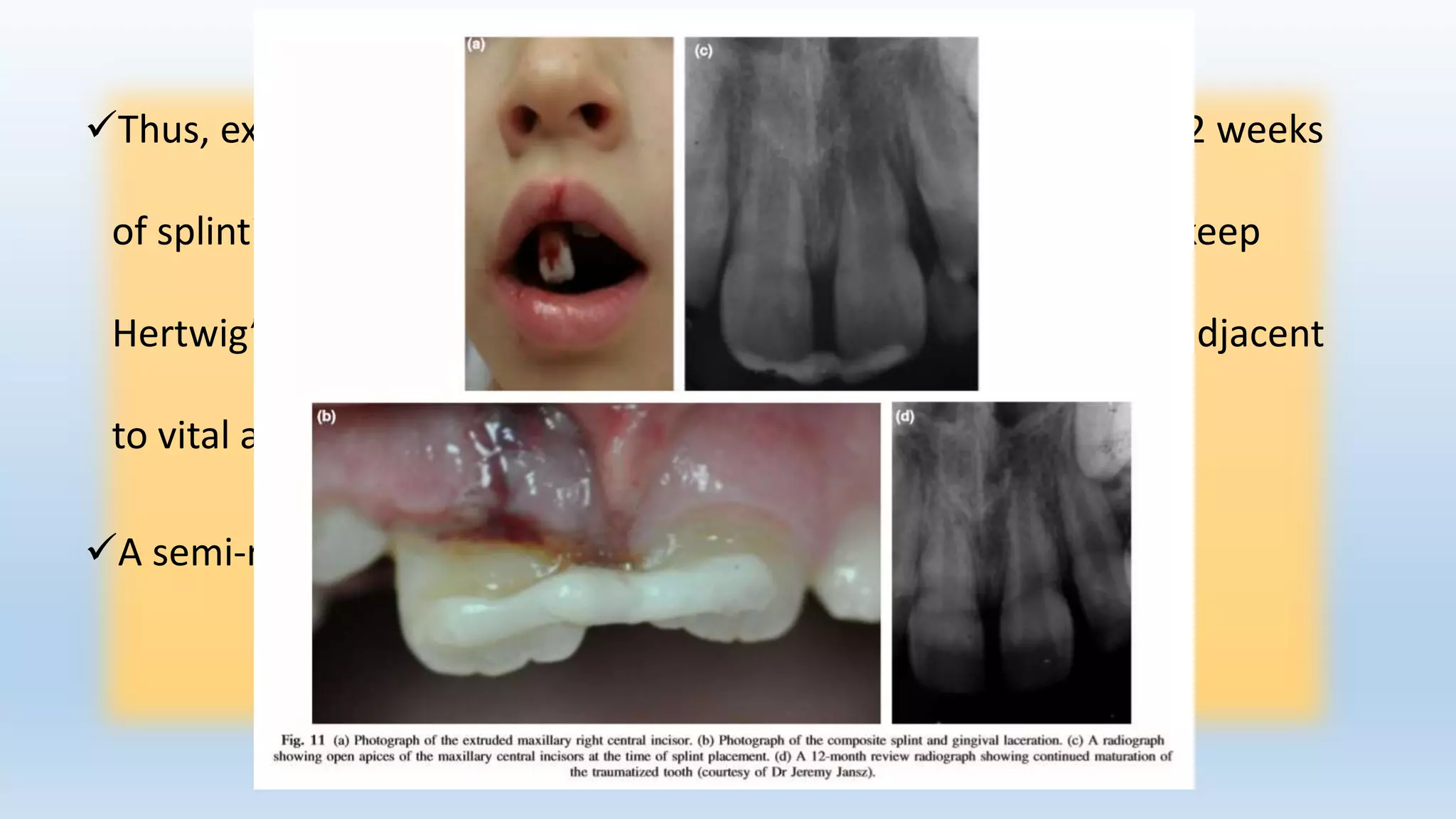 Splinting of traumatized teeth | PPTX