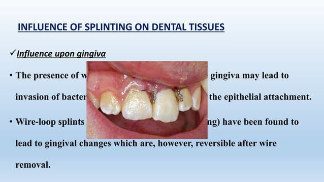 Splinting of traumatized teeth | PPTX