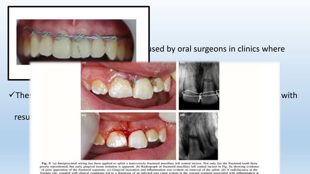 Splinting of traumatized teeth | PPTX
