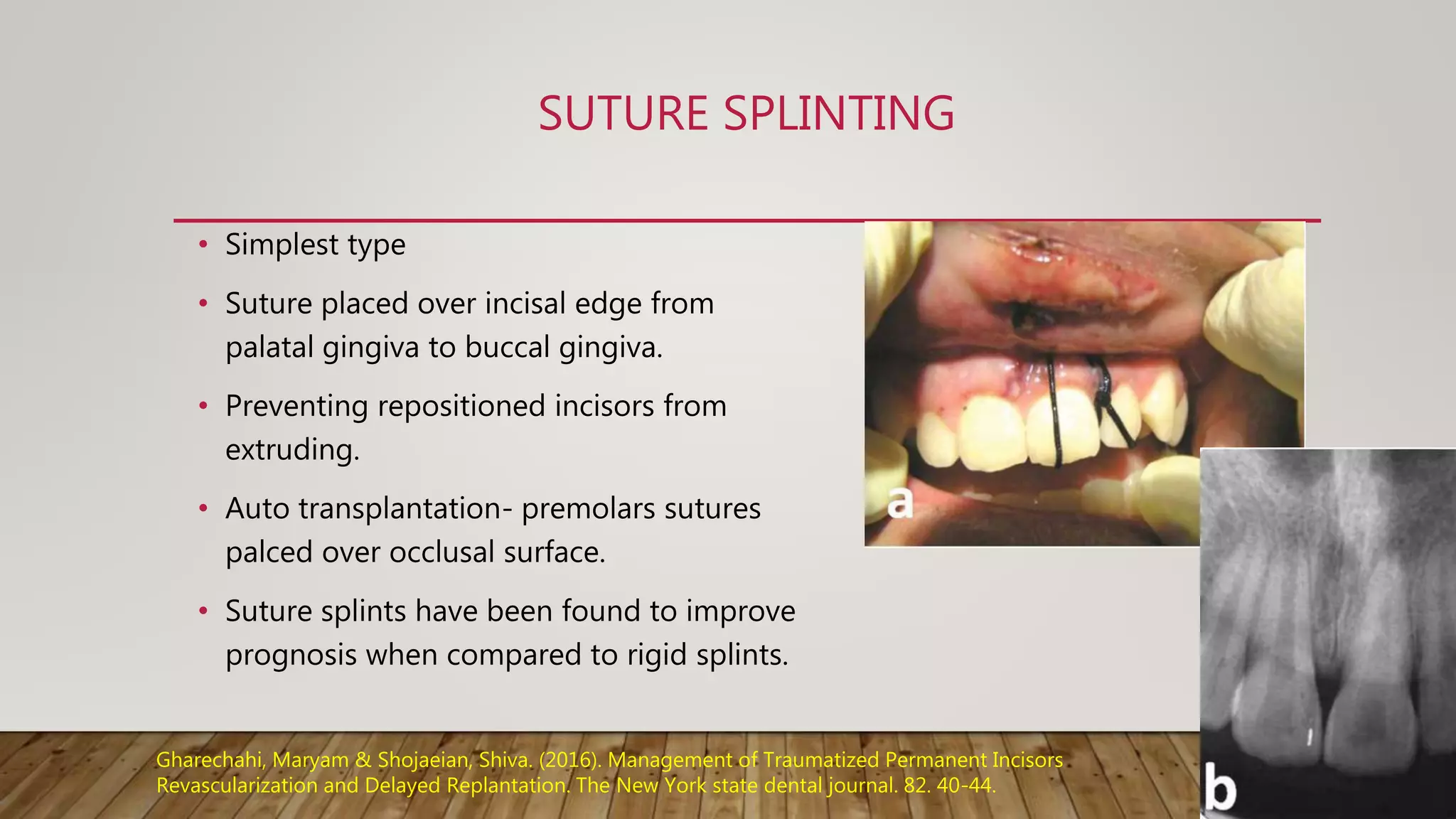 Splinting of traumatized teeth | PPTX