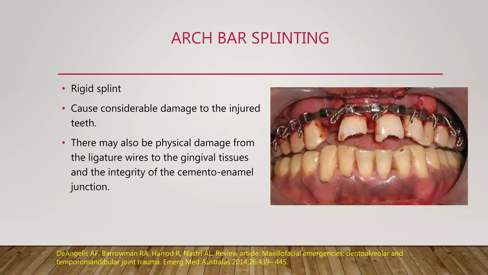 Splinting of traumatized teeth | PPTX