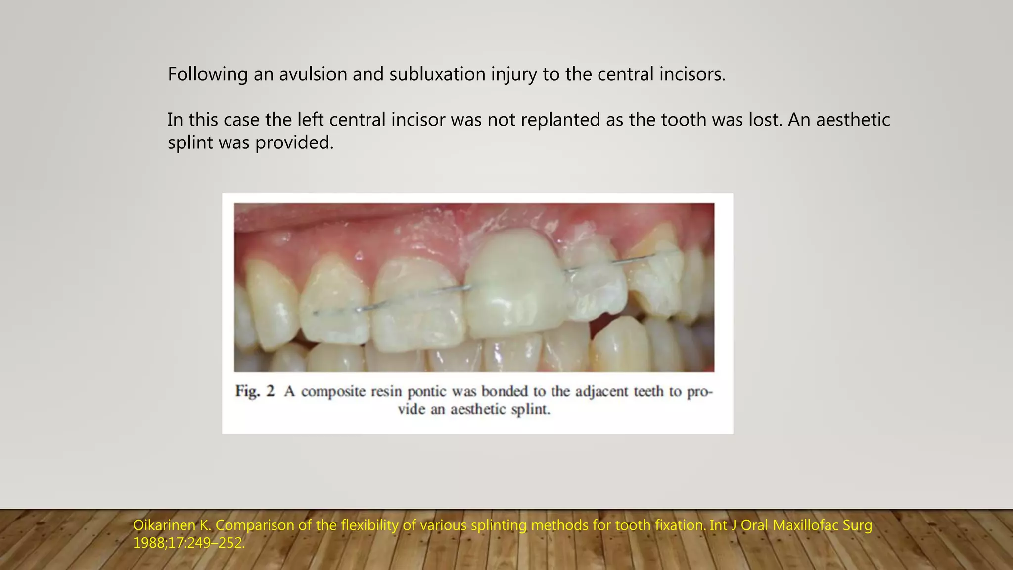 Splinting of traumatized teeth | PPTX