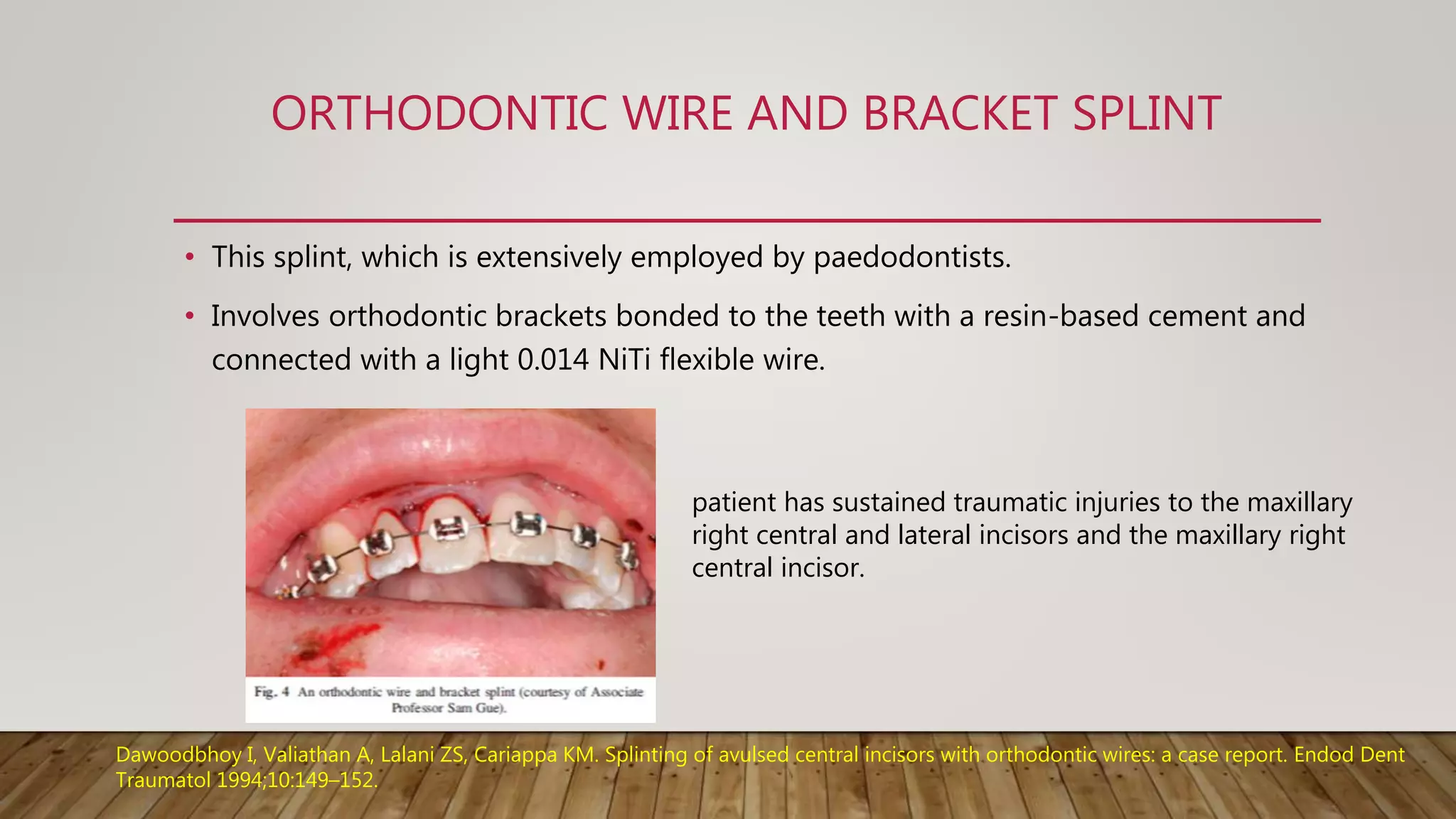 Splinting of traumatized teeth | PPTX