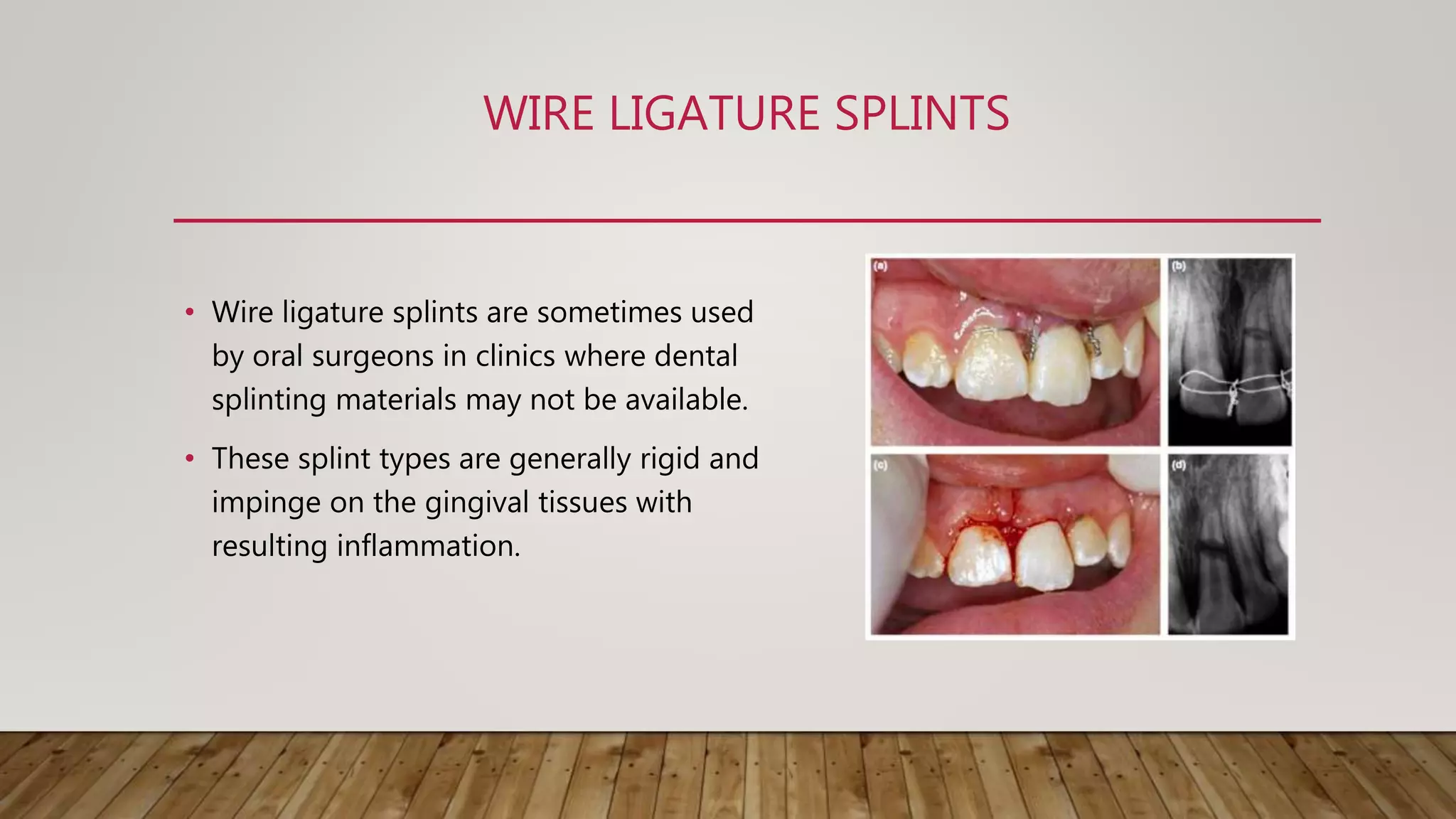 Splinting of traumatized teeth | PPTX