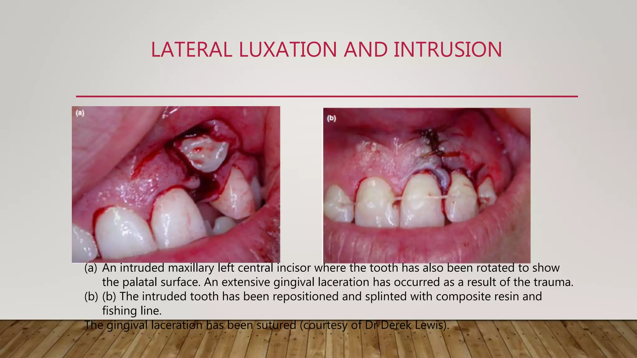 Splinting of traumatized teeth | PPTX