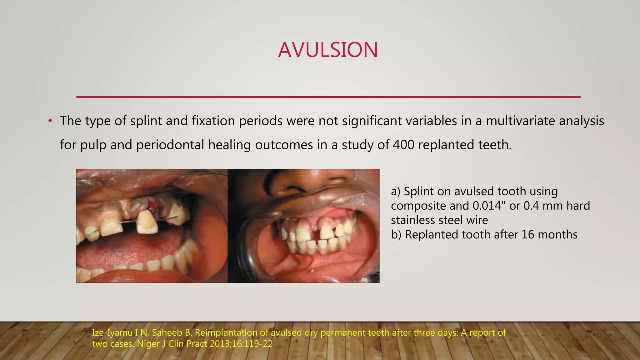 Splinting of traumatized teeth | PPTX