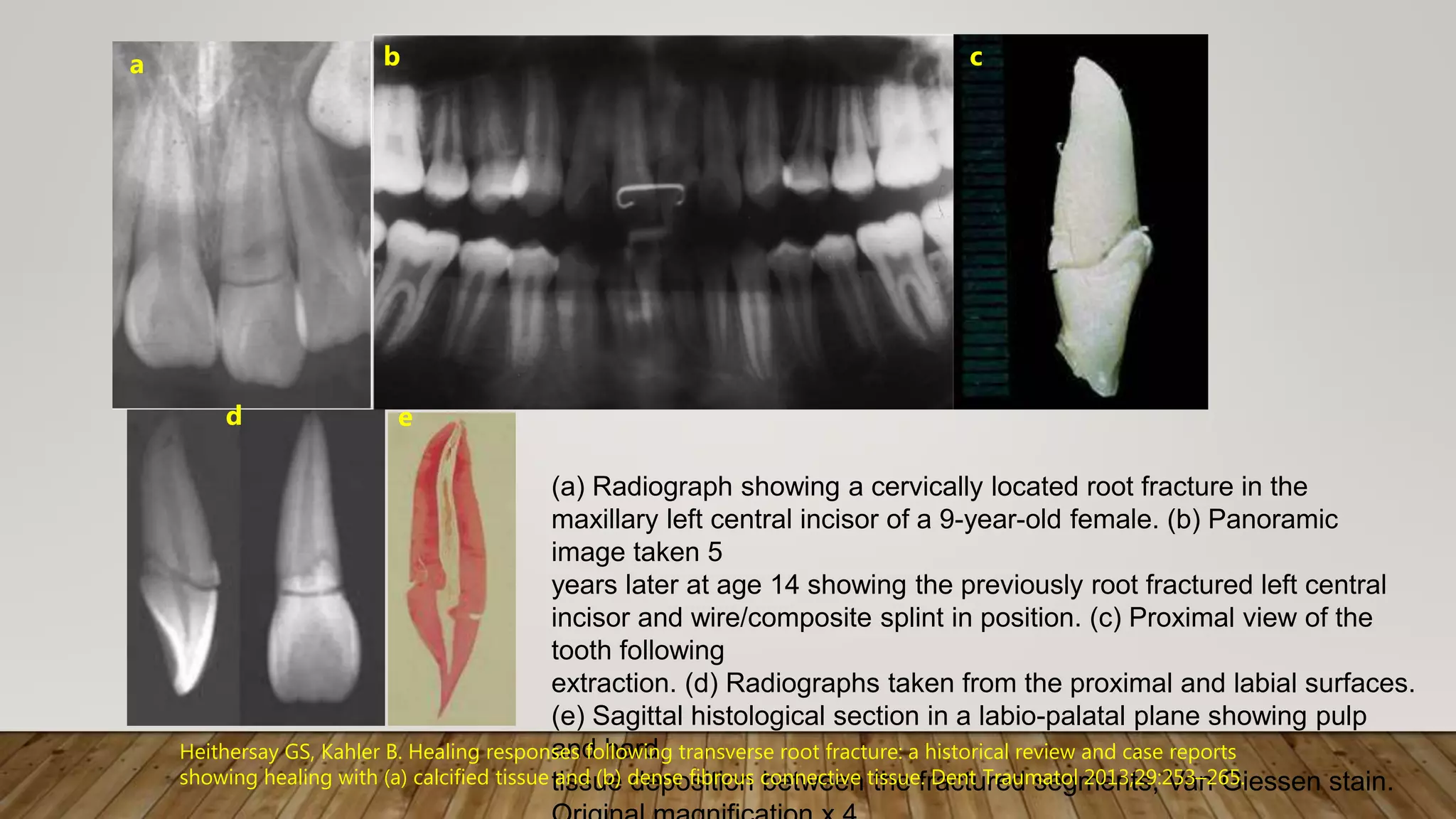 Splinting of traumatized teeth | PPTX