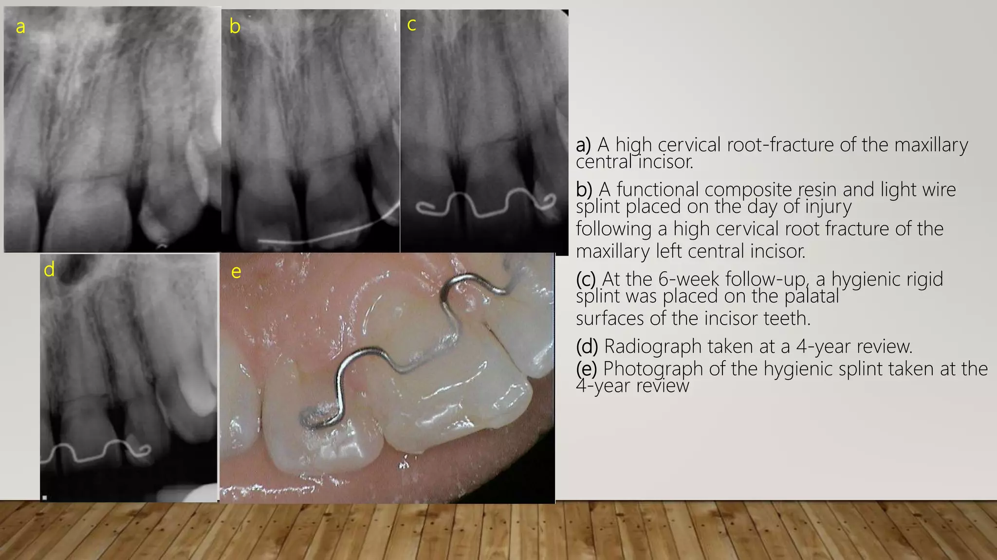 Splinting of traumatized teeth | PPTX