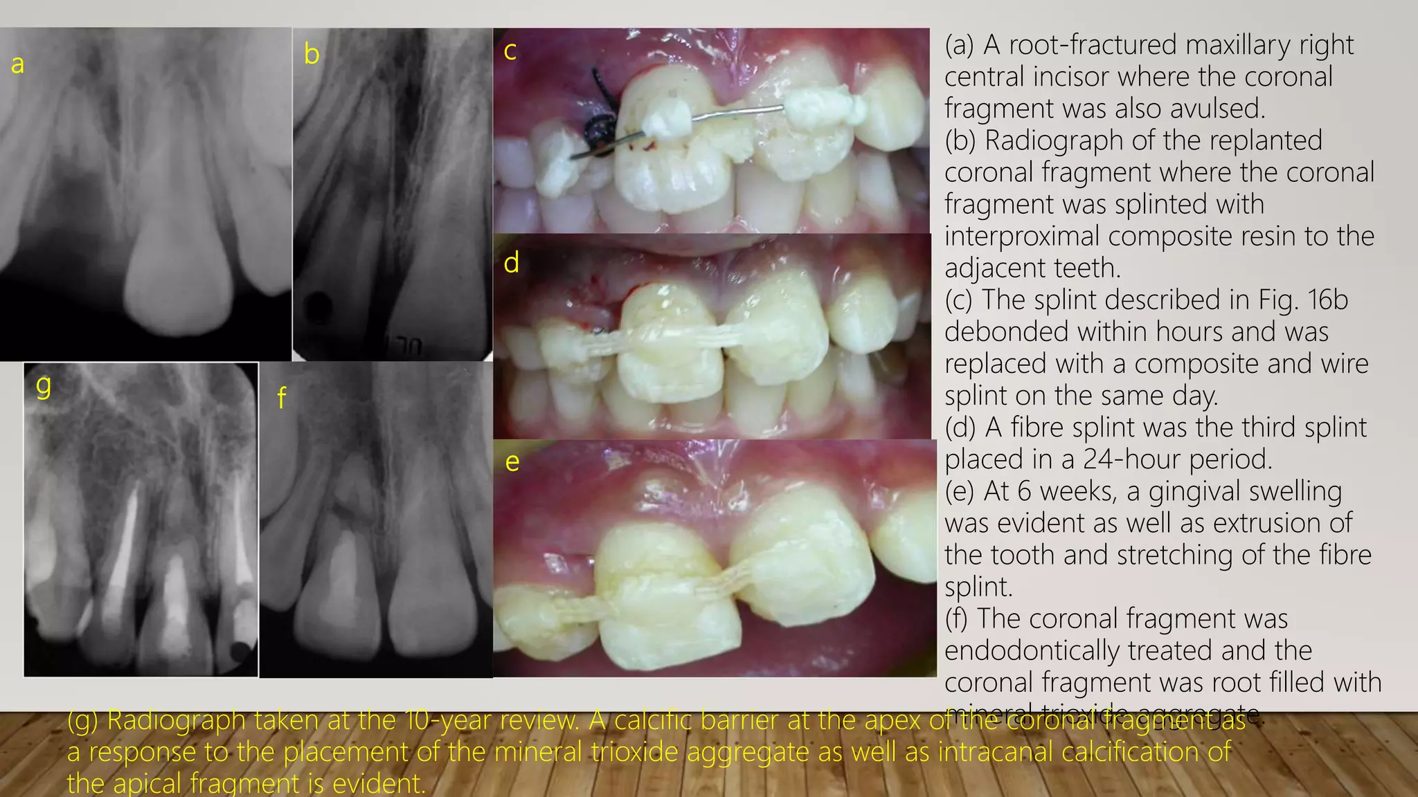 Splinting of traumatized teeth | PPTX