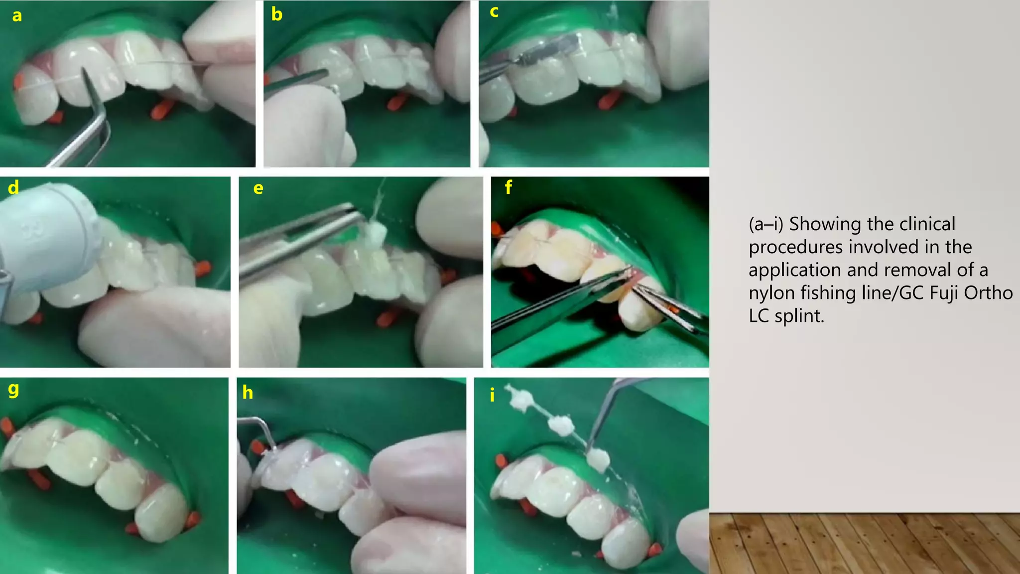 Splinting of traumatized teeth | PPTX