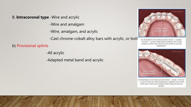 Splinting of traumatized teeth | PPTX