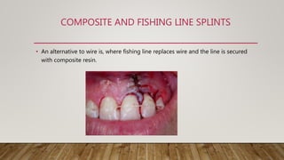 Splinting of traumatized teeth | PPTX