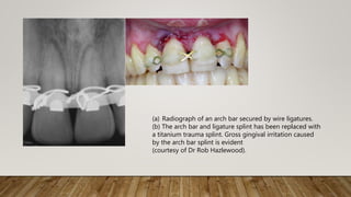 Splinting of traumatized teeth | PPTX