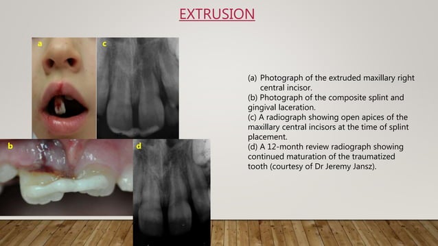 Splinting of traumatized teeth | PPTX