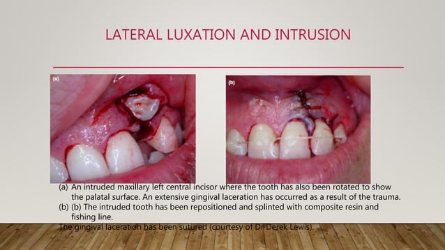 Splinting of traumatized teeth | PPTX