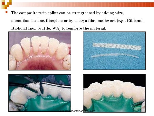 Splinting part i /certified fixed orthodontic courses by Indian denta…