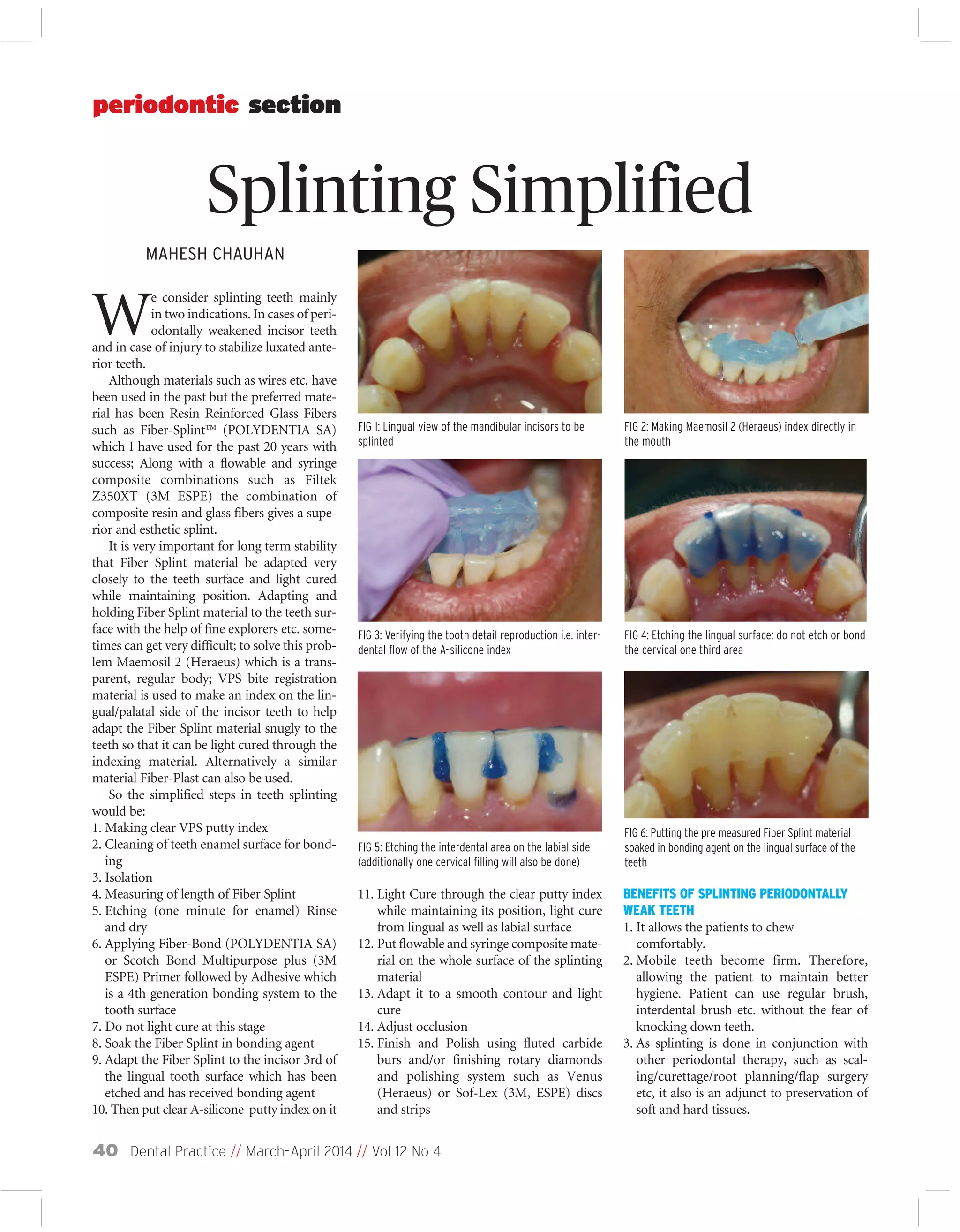 Splinting simplified dr mahesh chauhan | PDF