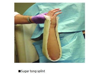 Different Splinting Techniques of Fractures.pptx