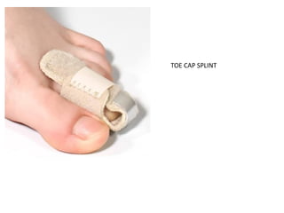 Different Splinting Techniques of Fractures.pptx