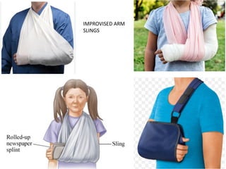 Different Splinting Techniques of Fractures.pptx