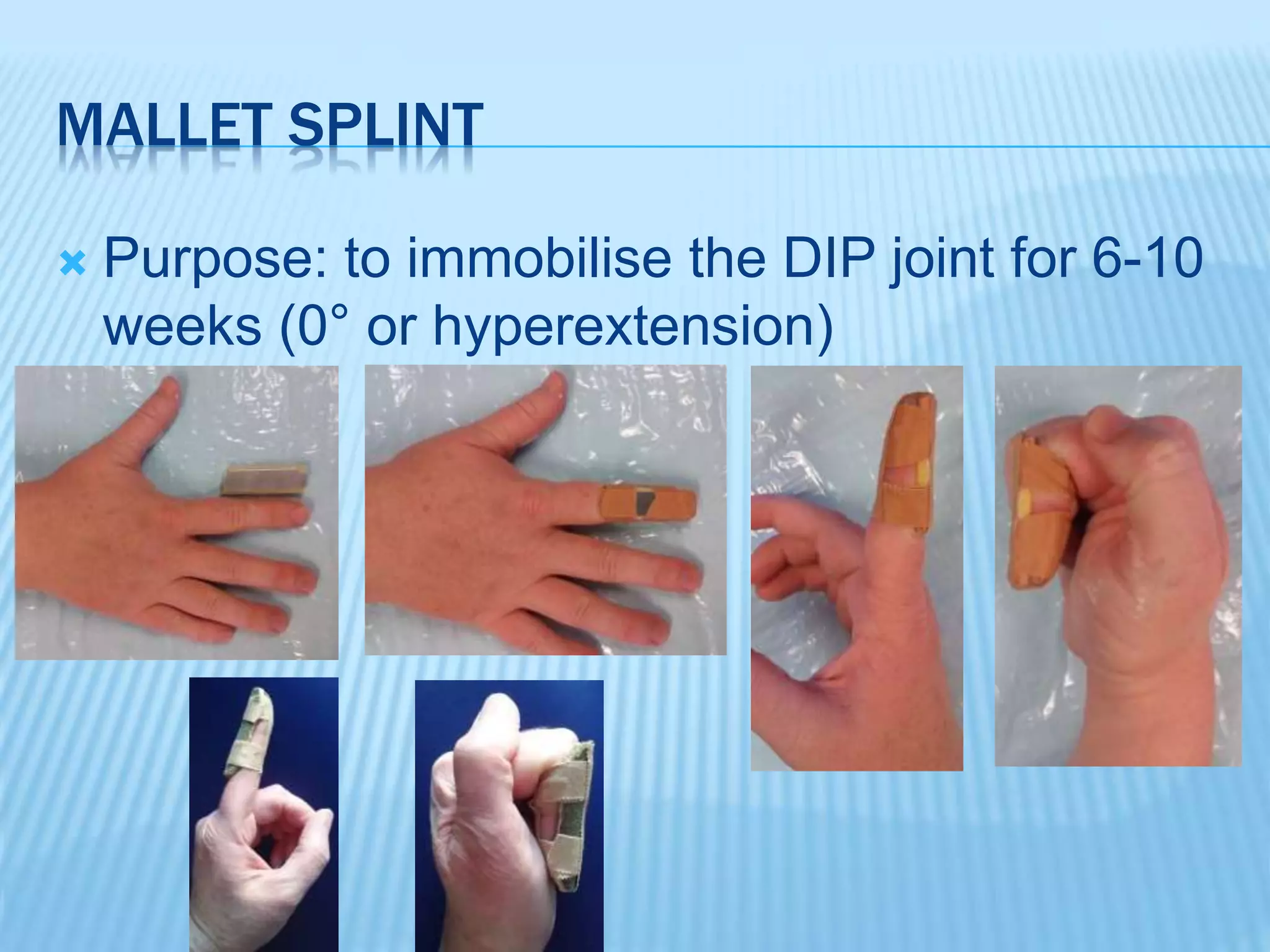 Splinting when you have no therapists | PPTX