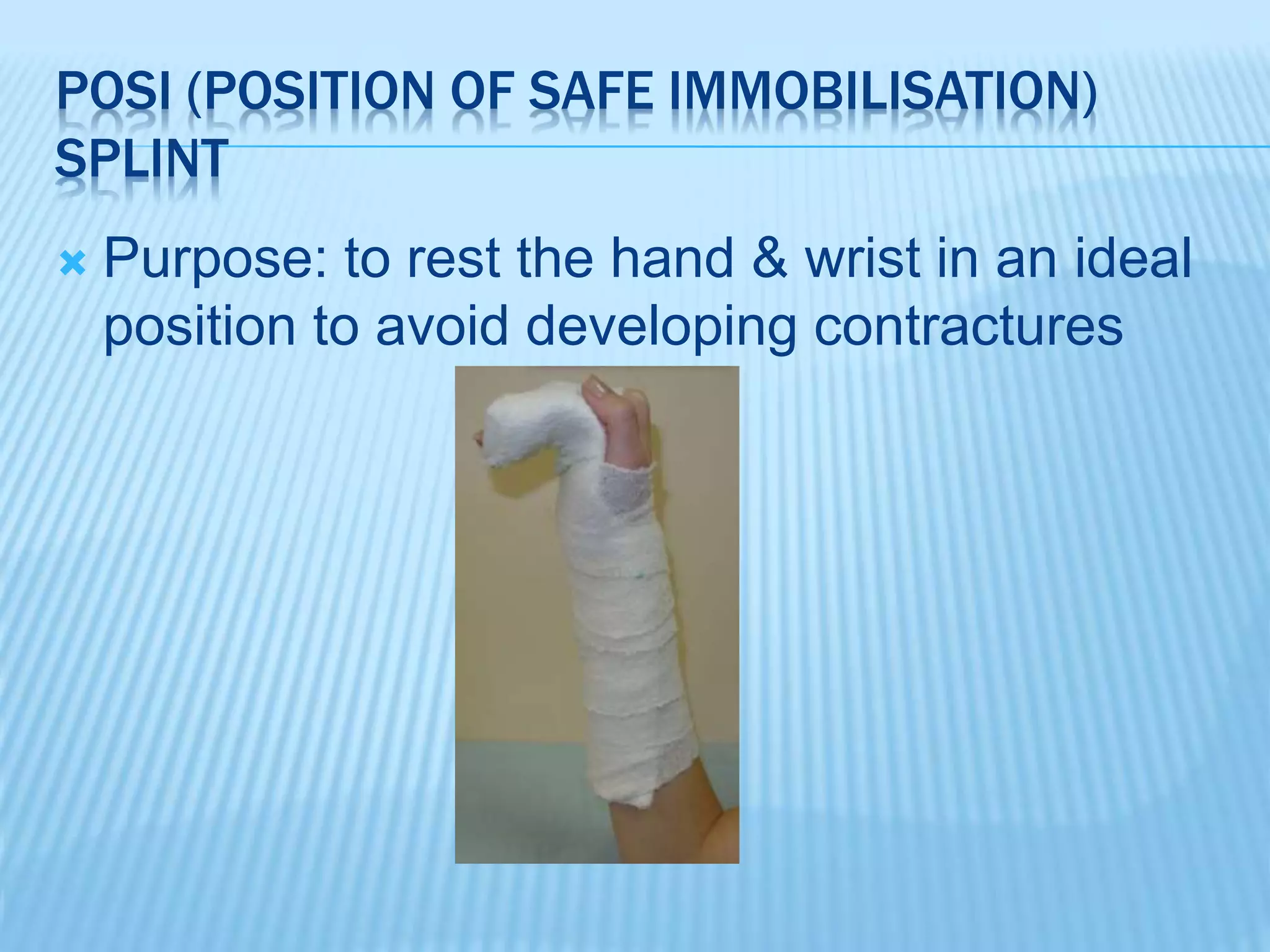 Splinting when you have no therapists | PPTX