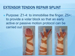 Splinting when you have no therapists | PPTX