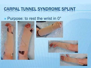 Splinting when you have no therapists | PPTX