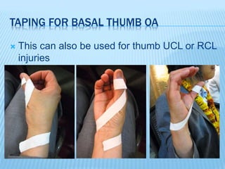 Splinting when you have no therapists | PPTX