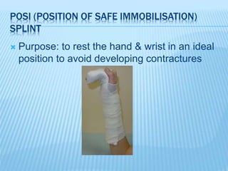 Splinting when you have no therapists | PPTX