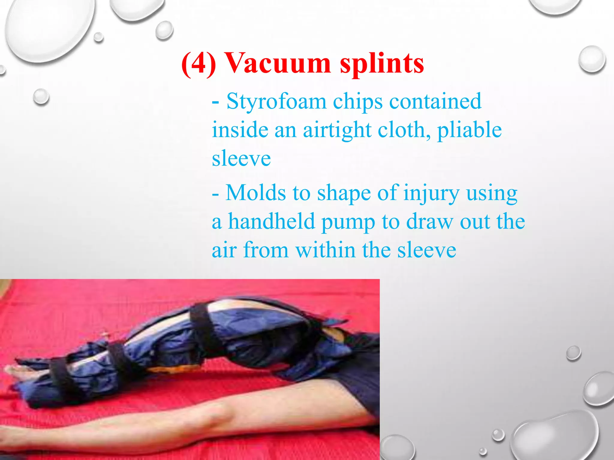 Splint ppt by rupeshkumar | PPTX