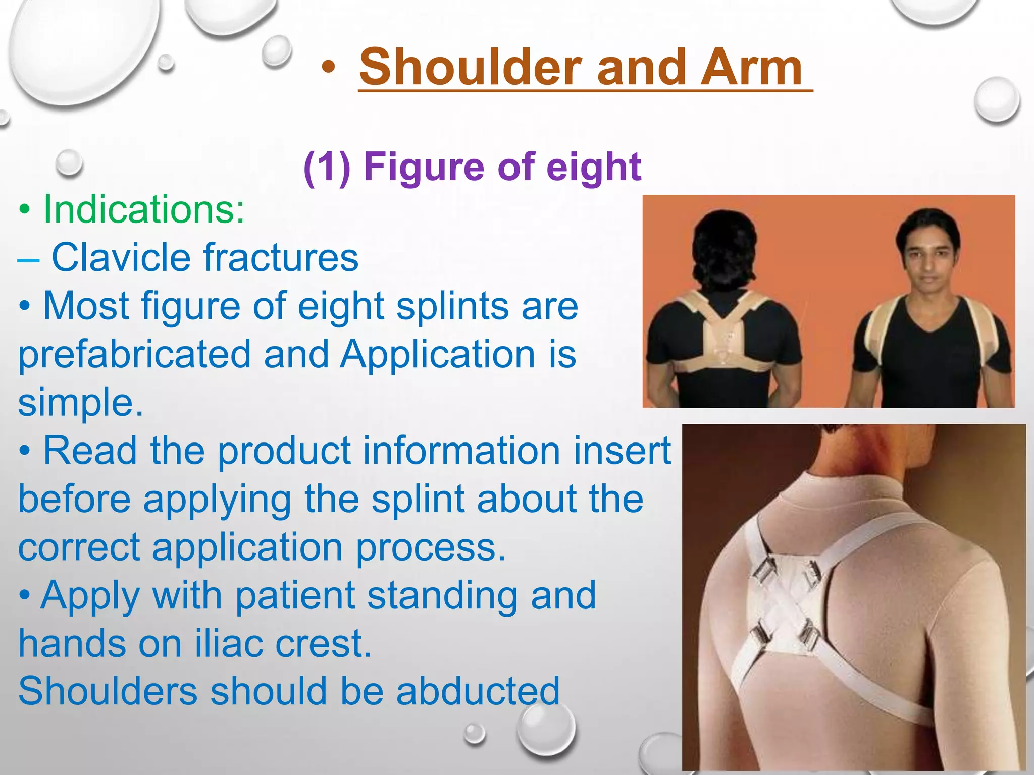 Splint ppt by rupeshkumar | PPTX