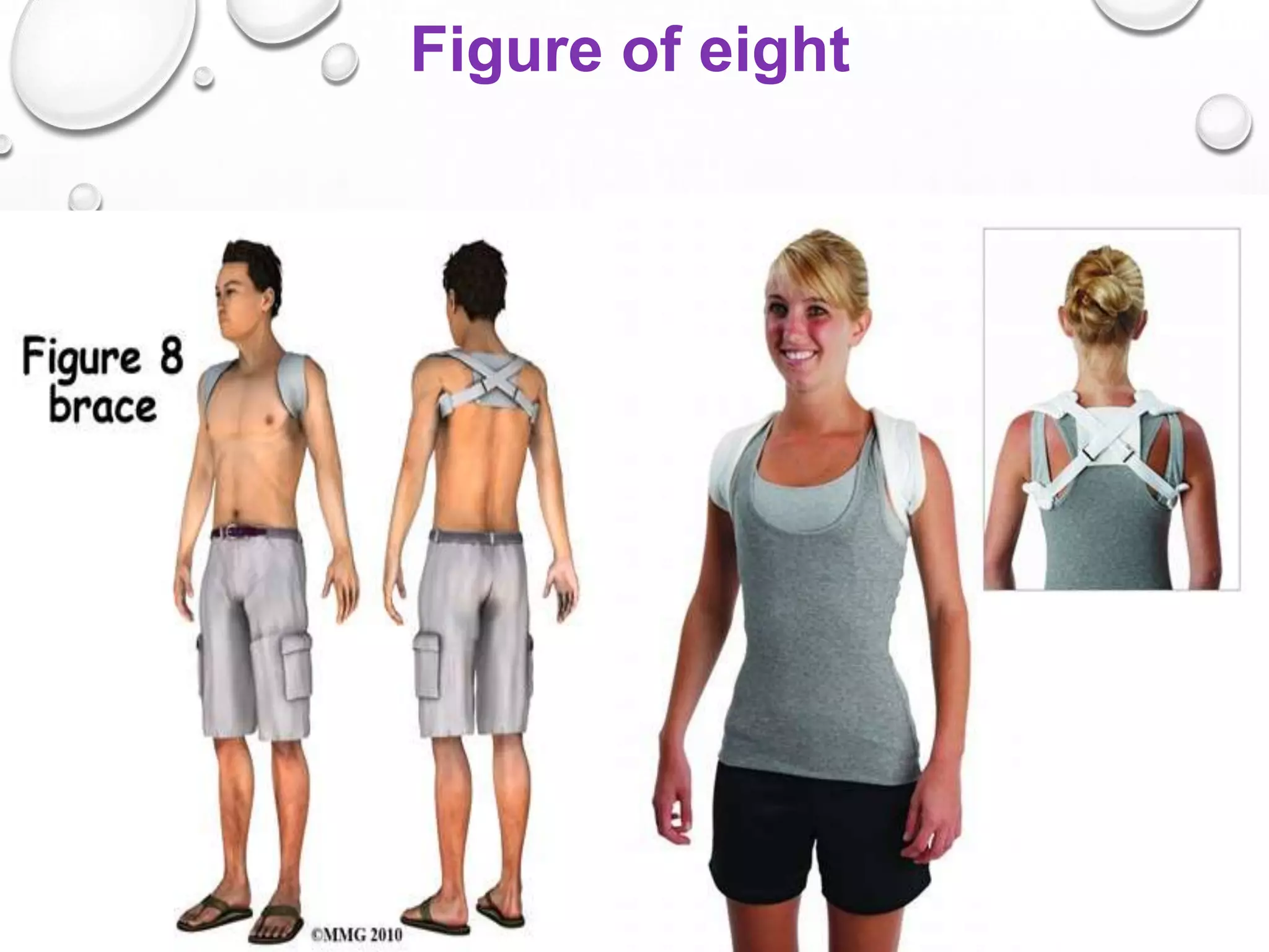 Splint ppt by rupeshkumar | PPTX