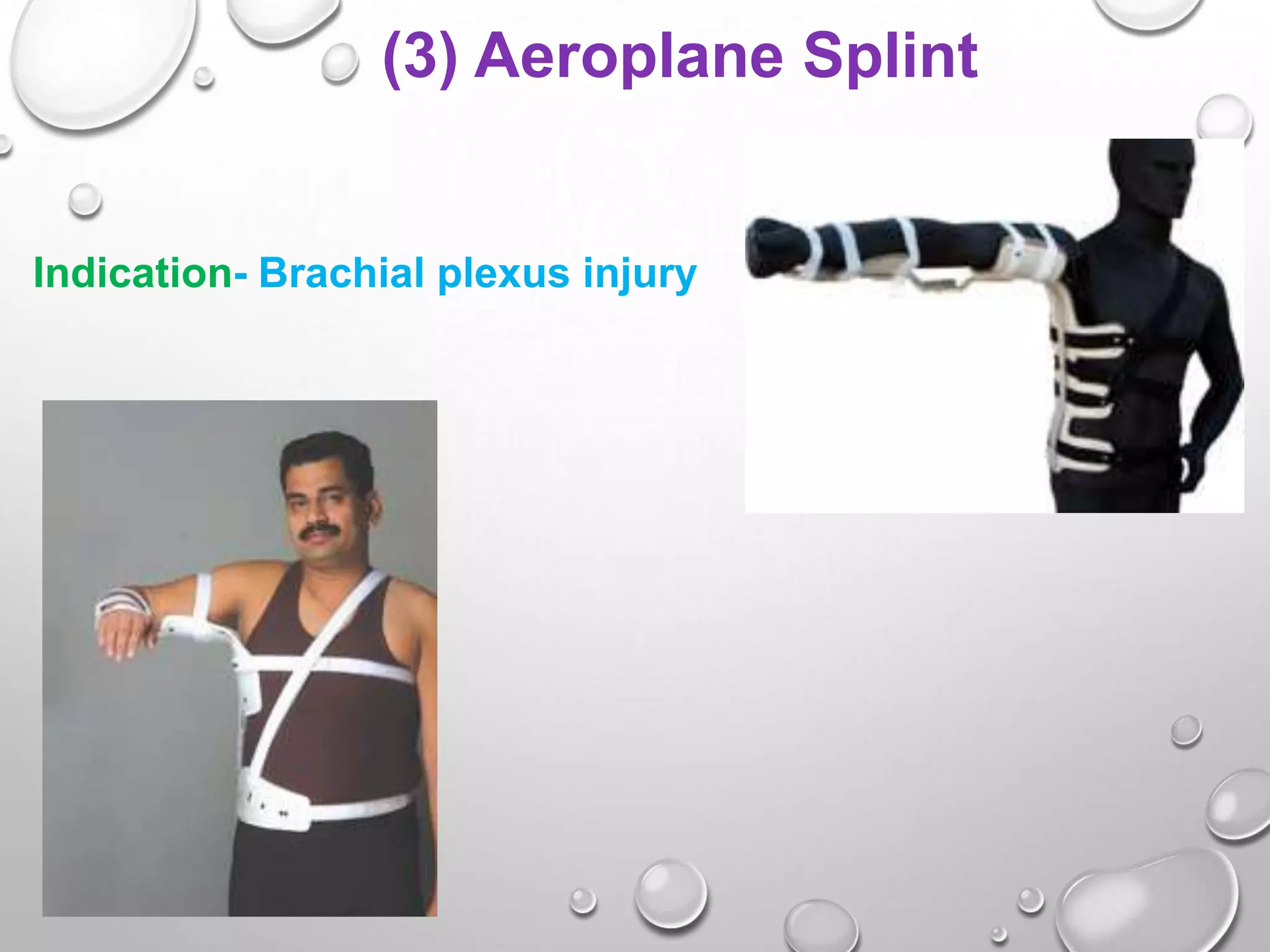 Splint ppt by rupeshkumar | PPTX