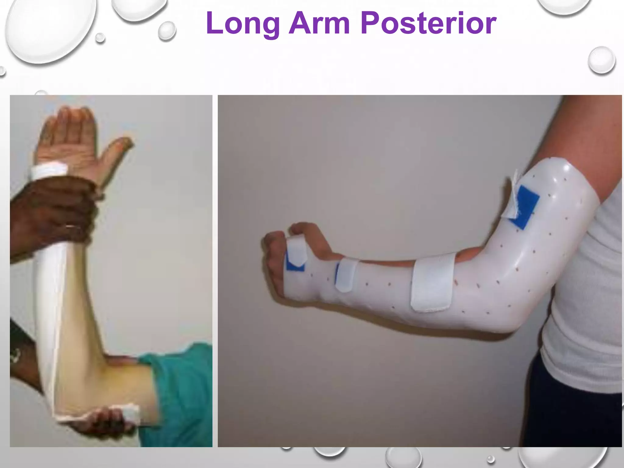 Splint ppt by rupeshkumar | PPTX