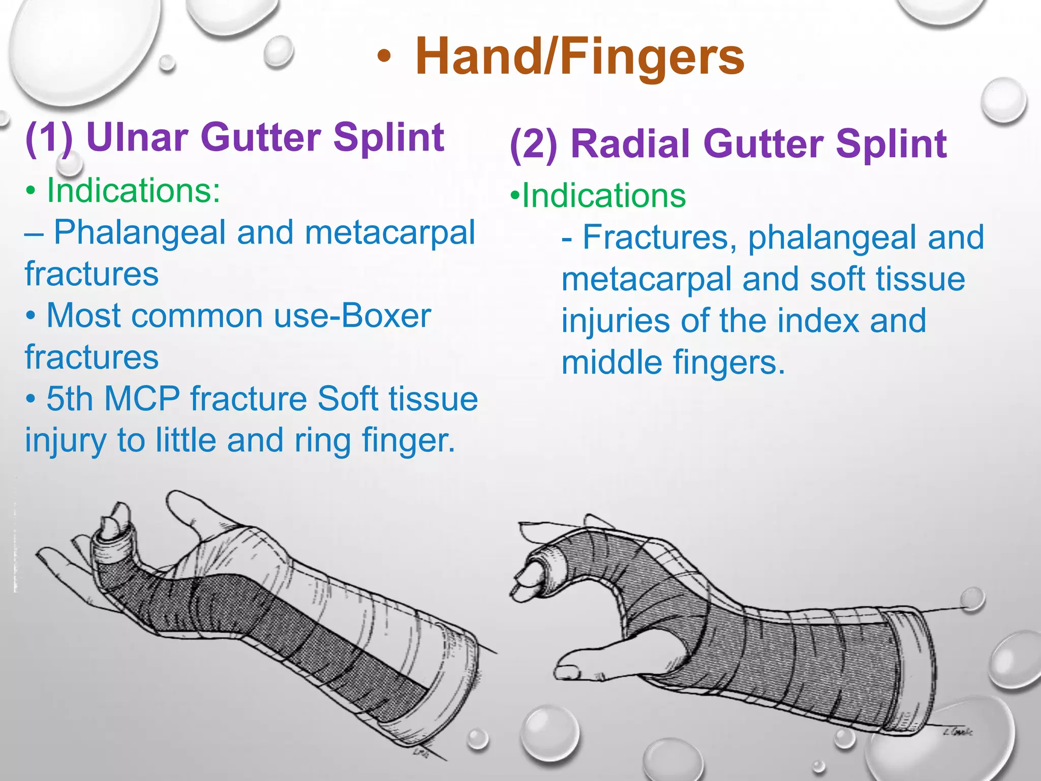 Splint ppt by rupeshkumar | PPTX