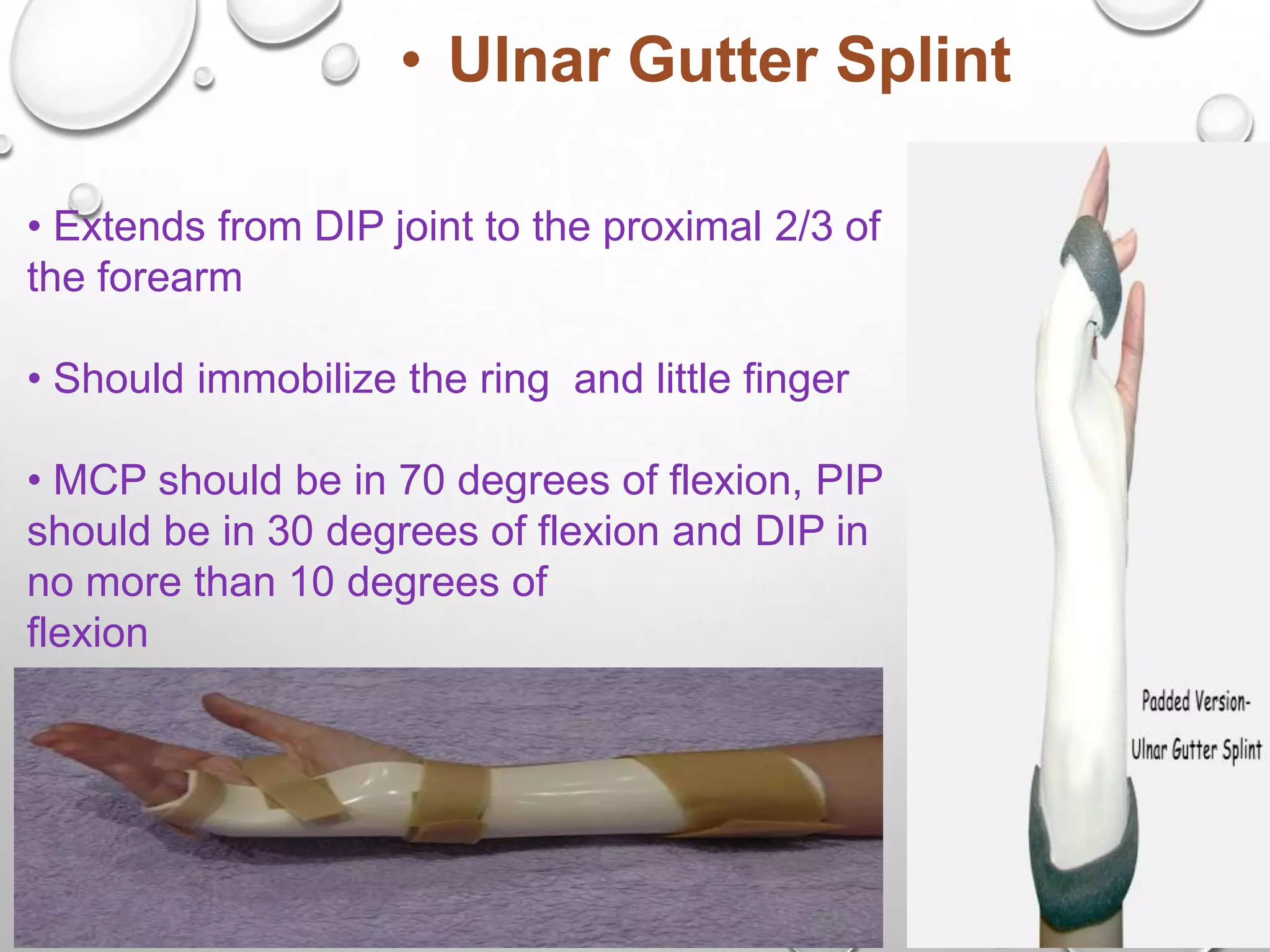 Splint ppt by rupeshkumar | PPTX