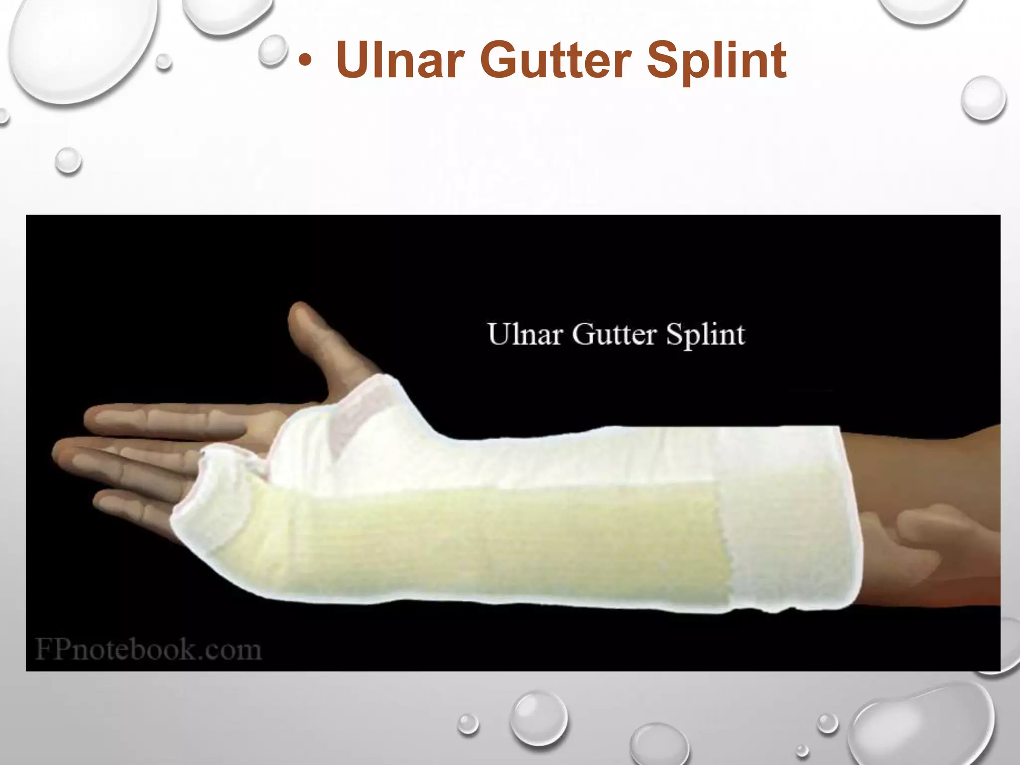 Splint ppt by rupeshkumar | PPTX