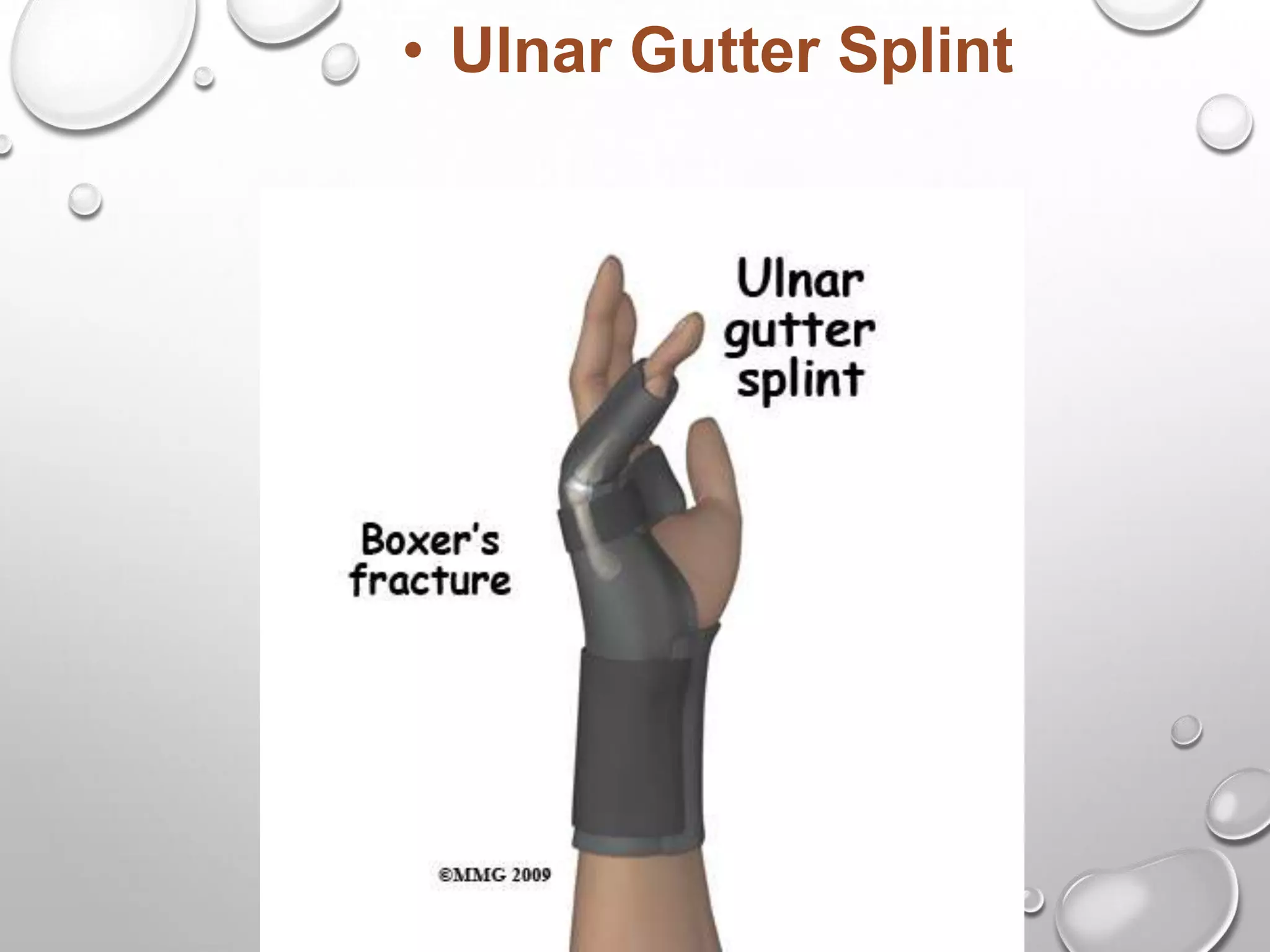 Splint ppt by rupeshkumar | PPTX