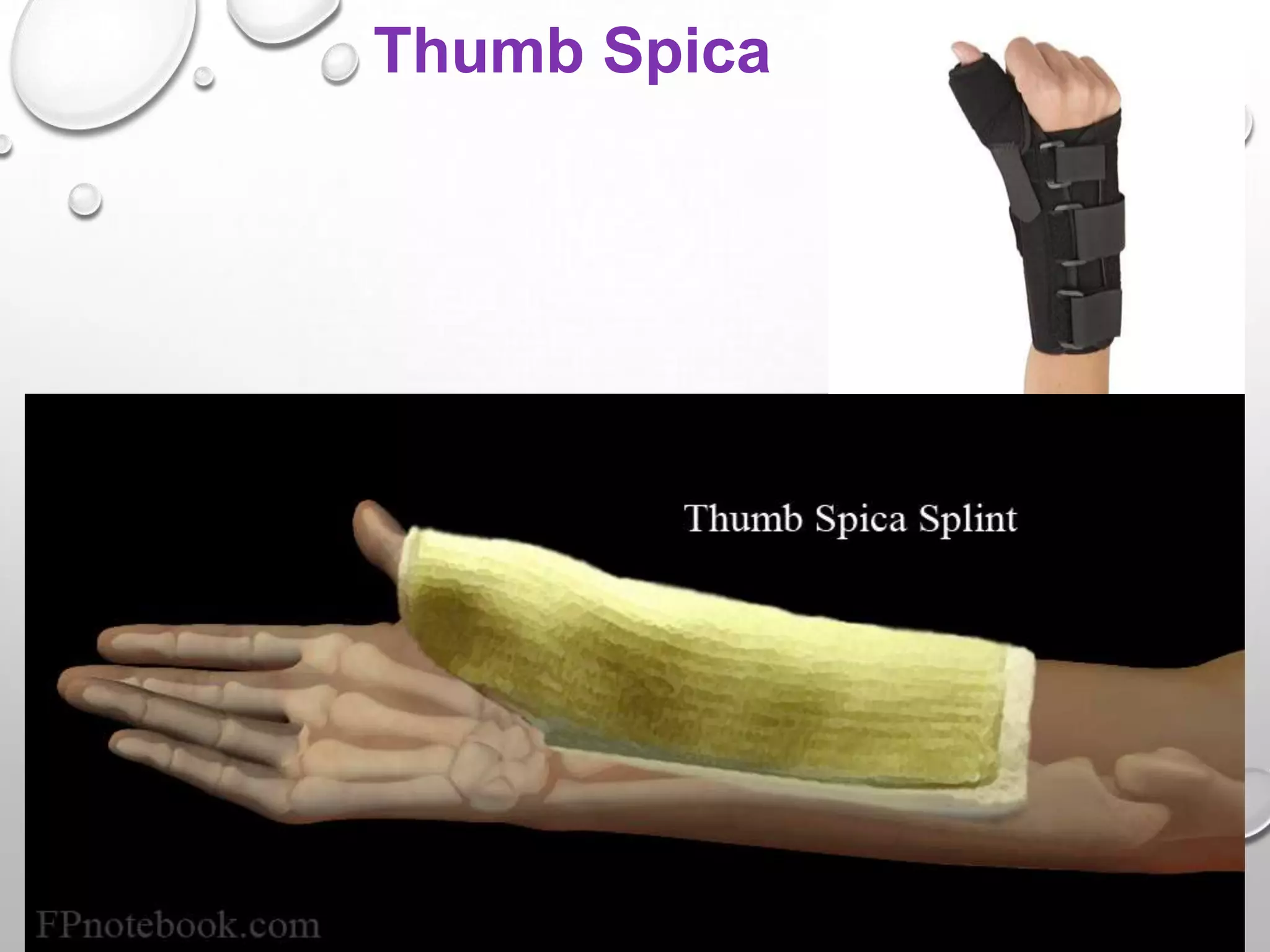 Splint ppt by rupeshkumar | PPTX
