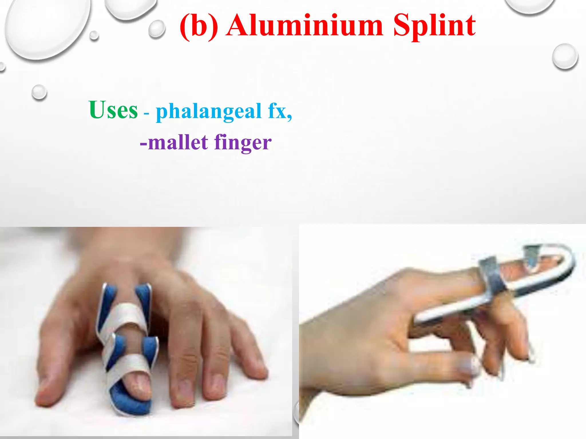 Splint ppt by rupeshkumar | PPTX