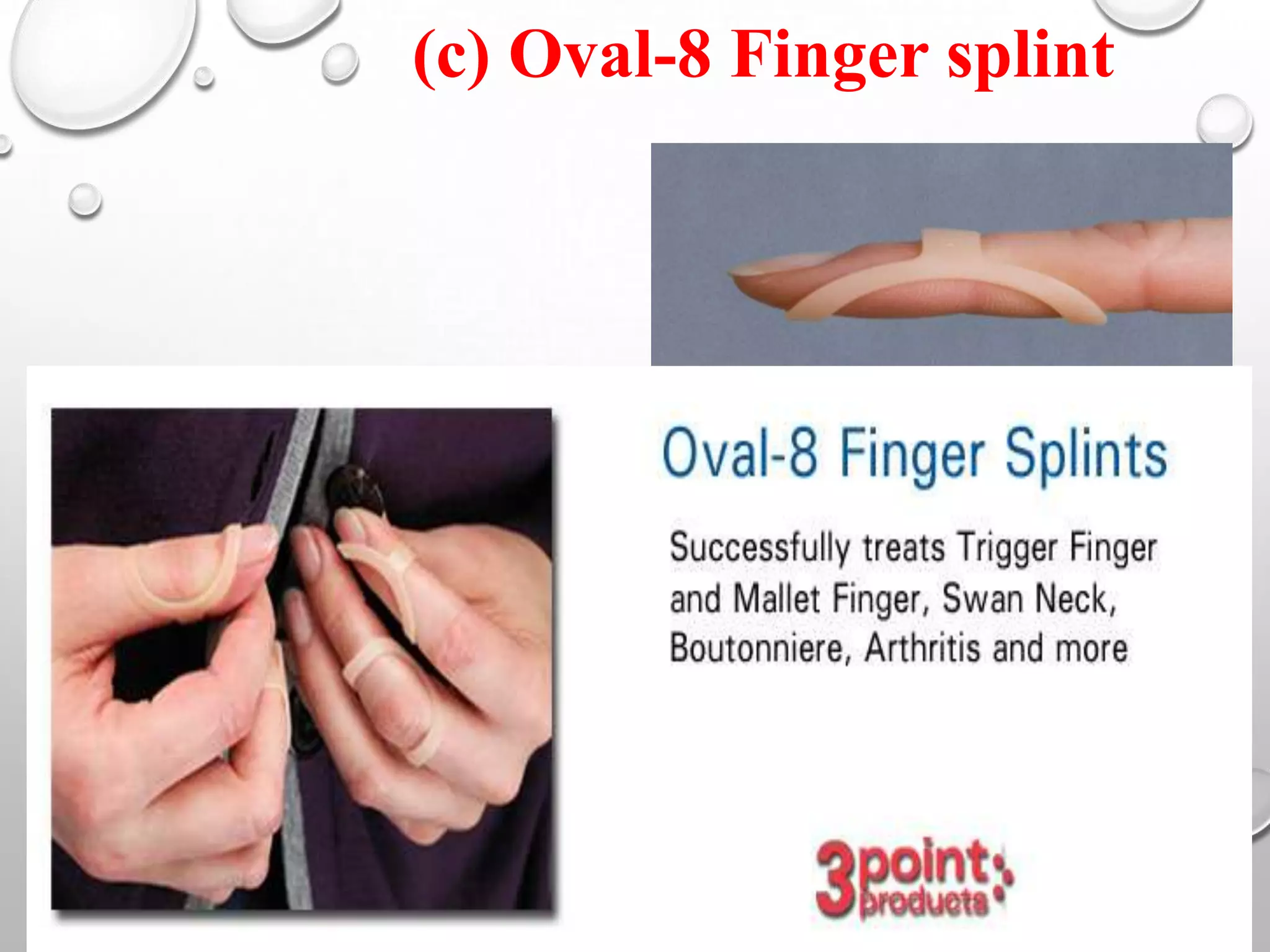 Splint ppt by rupeshkumar | PPTX