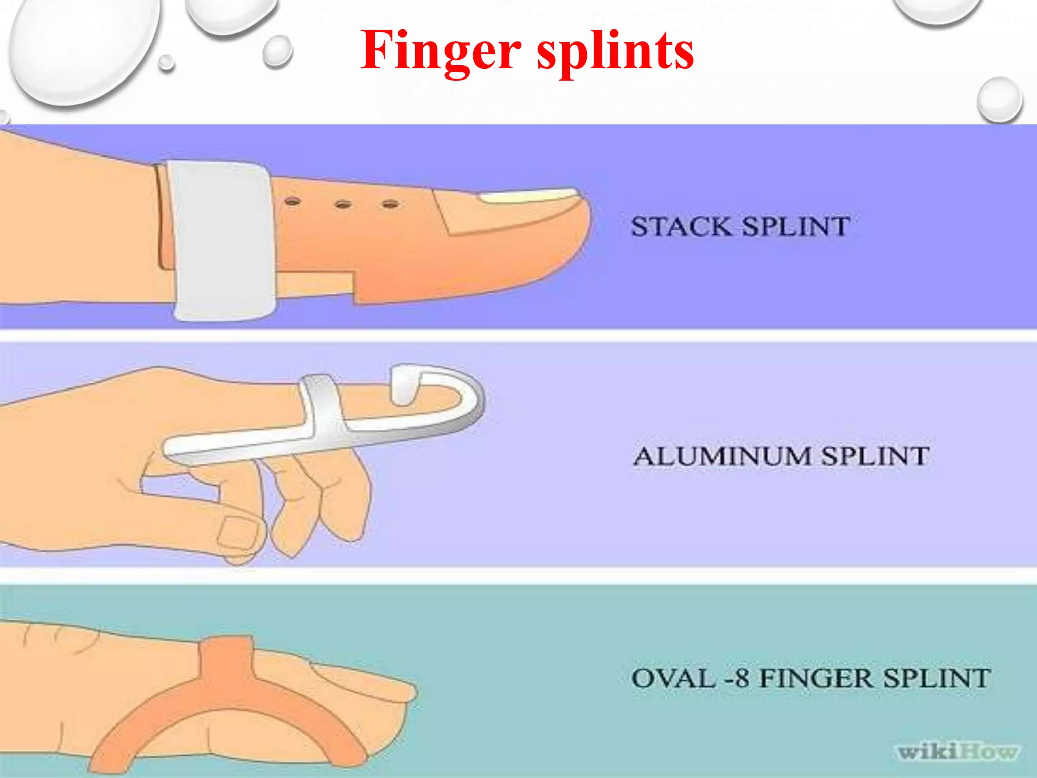 Splint ppt by rupeshkumar | PPTX