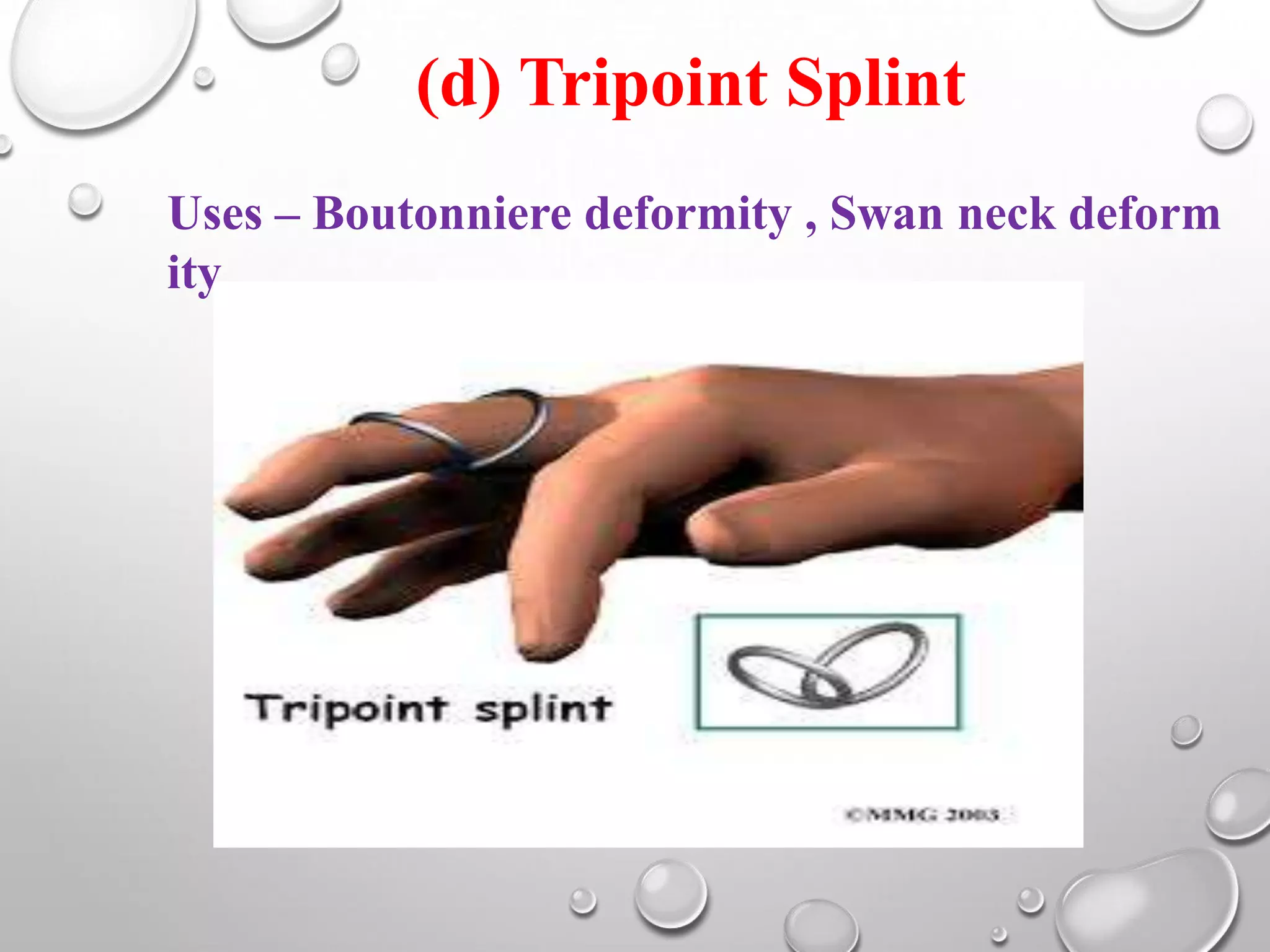 Splint ppt by rupeshkumar | PPTX